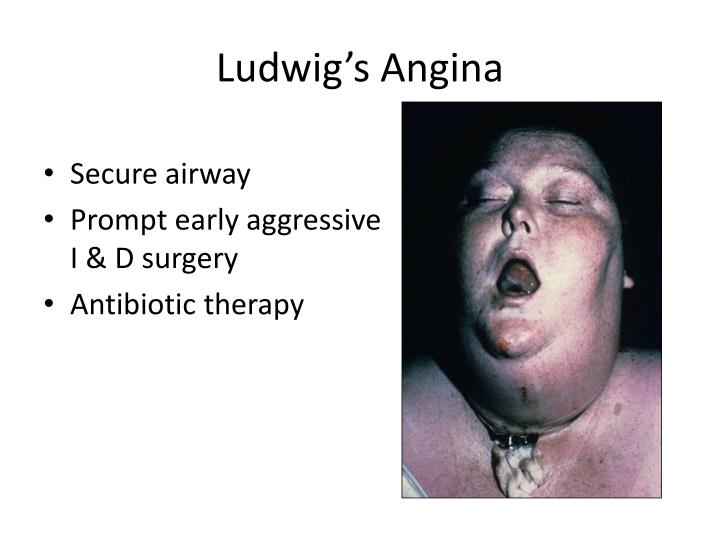 PPT - Complex Odontogenic Infections PowerPoint Presentation - ID:1944812
