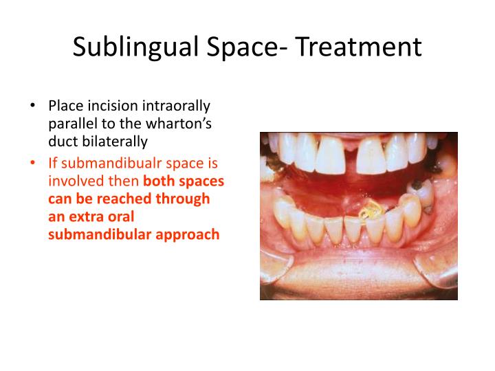 PPT - Complex Odontogenic Infections PowerPoint Presentation - ID:1944812
