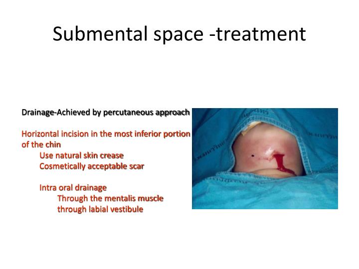 PPT - Complex Odontogenic Infections PowerPoint Presentation - ID:1944812