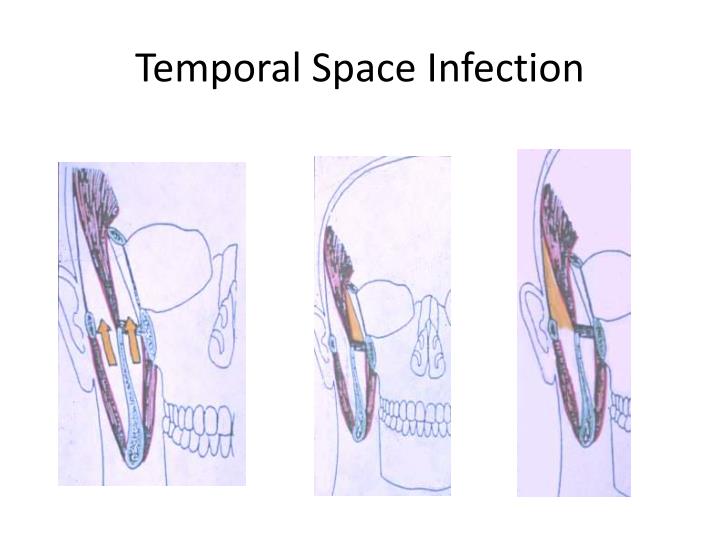 PPT - Complex Odontogenic Infections PowerPoint Presentation - ID:1944812