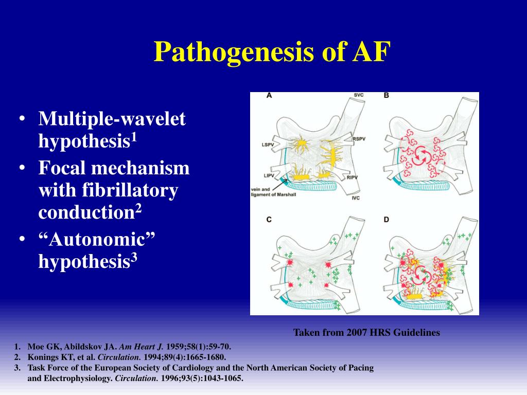 PPT - Contemporary Surgical Therapy for Atrial Fibrillation PowerPoint ...