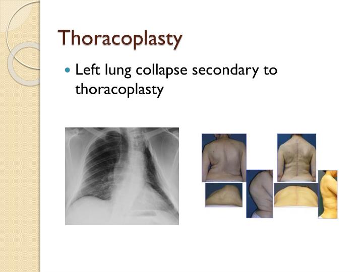 PPT - Pulmonary tuberculosis PowerPoint Presentation - ID:1945699