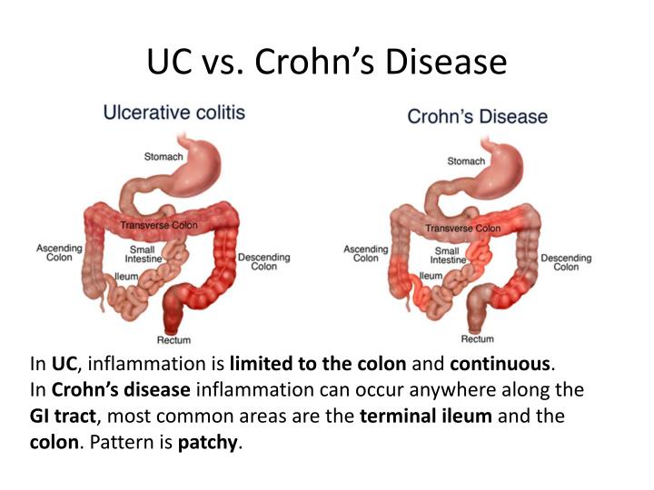 Ppt Ulcerative Colitis Powerpoint Presentation Id 1945751
