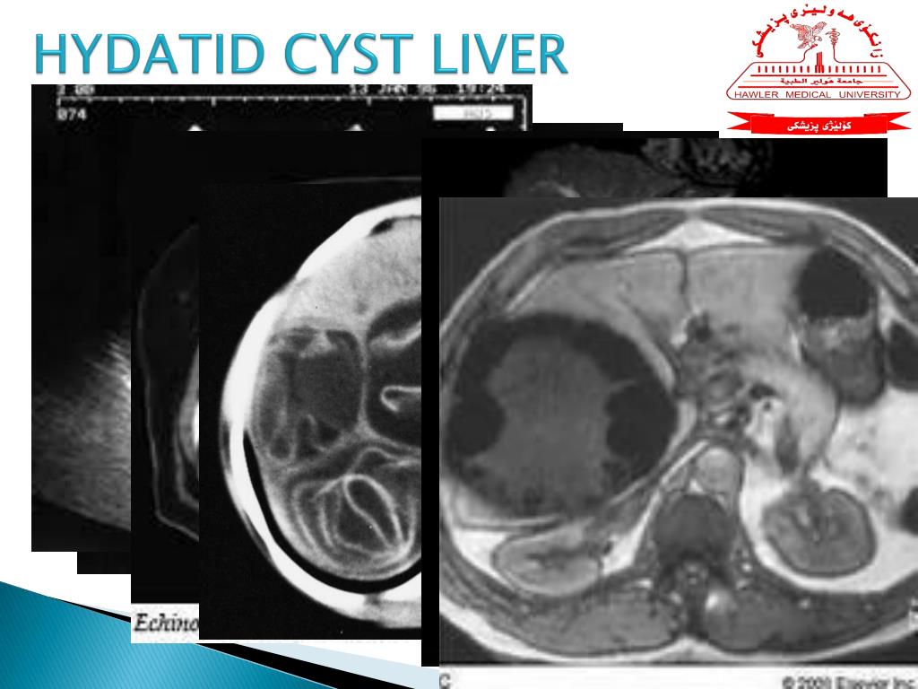 PPT - RADIOLOGY OF HEPATOBILIARY SYSTREM , PANCREAS AND SPLEEN ...