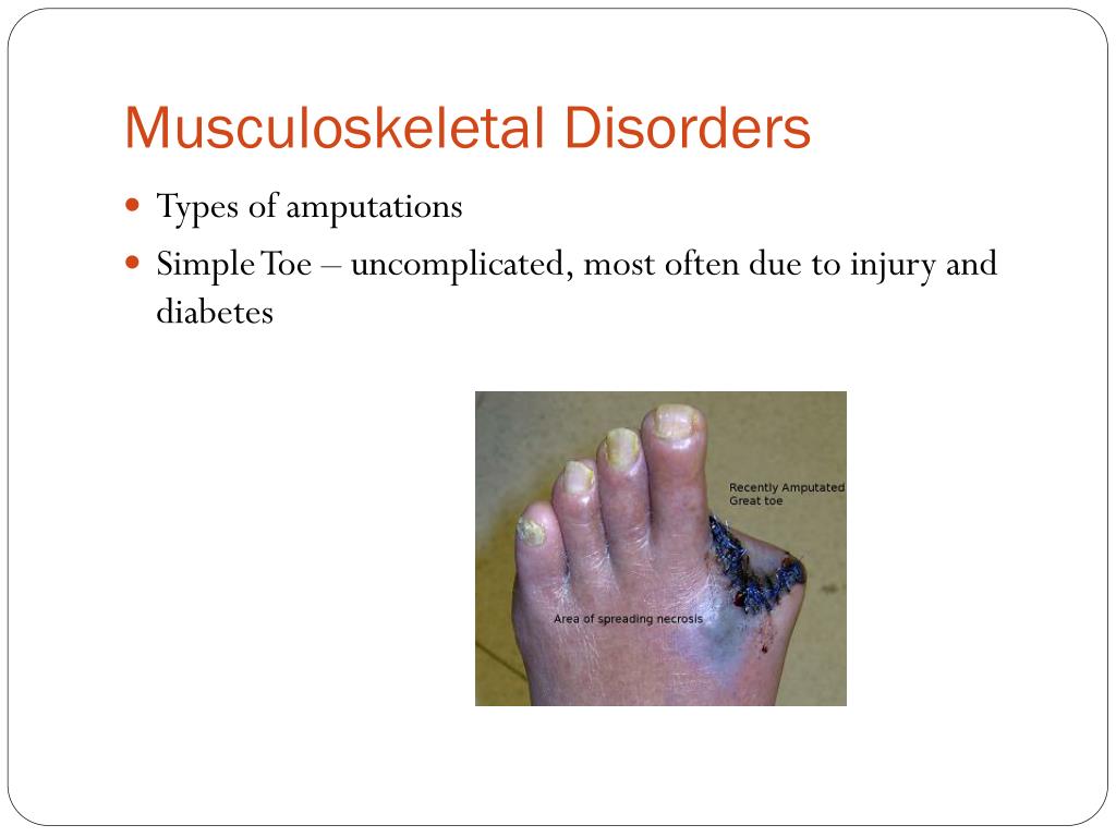 Ppt Musculoskeletal Disorders Part Ii Powerpoint Presentation Free