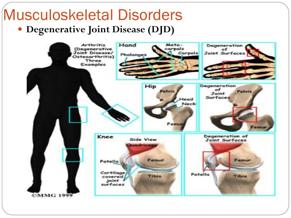 Ppt Musculoskeletal Disorders Part Ii Powerpoint Presentation Free