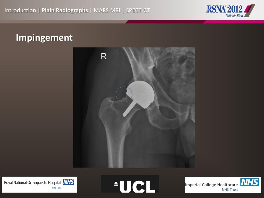 PPT - Multimodality Assessment of Metal-on-Metal Hip Arthroplasties ...
