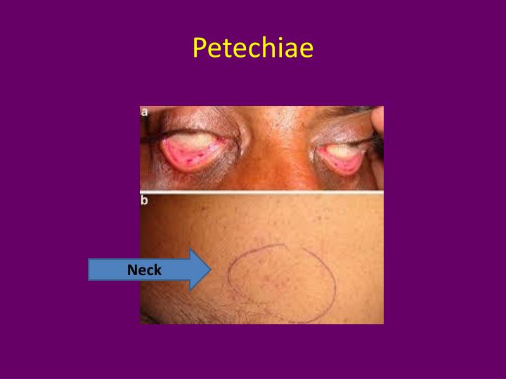 PPT - Fat Embolism Syndrome PowerPoint Presentation - ID:1957326