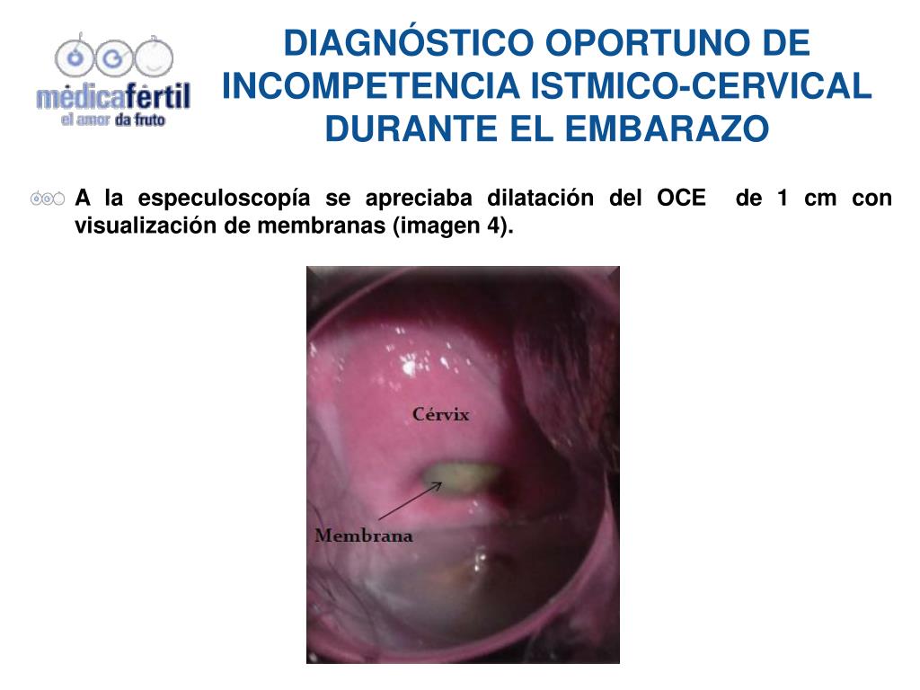 PPT - DIAGNÓSTICO OPORTUNO DE INCOMPETENCIA ISTMICO-CERVICAL DURANTE EL ...