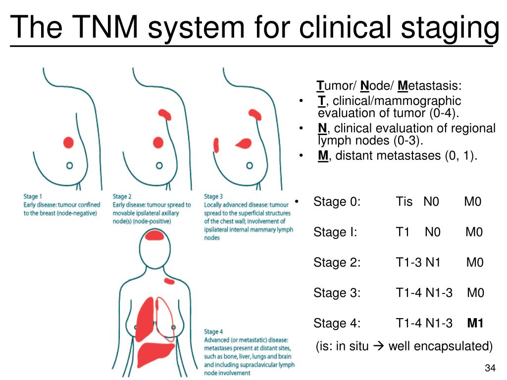 Tumor Node Metastasis Tnm Staging System For Lung Can - vrogue.co Tumor Node Metastasis Tnm Staging System For Lung Can - vrogue.co
