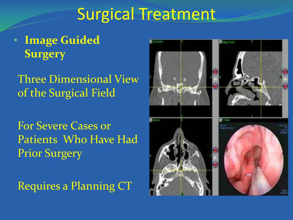 PPT - Sinusitis : Assessment, Diagnosis and Treatment Sometimes It I s ...