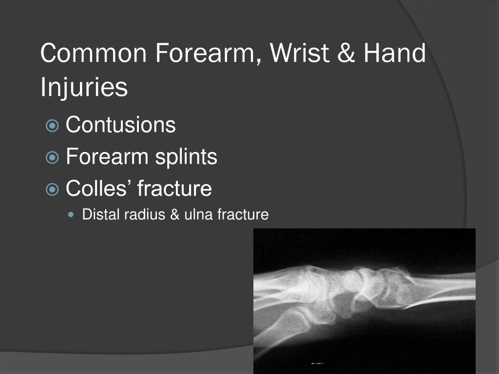 Ppt Forearm Wrist And Hand Evaluation Powerpoint Presentation