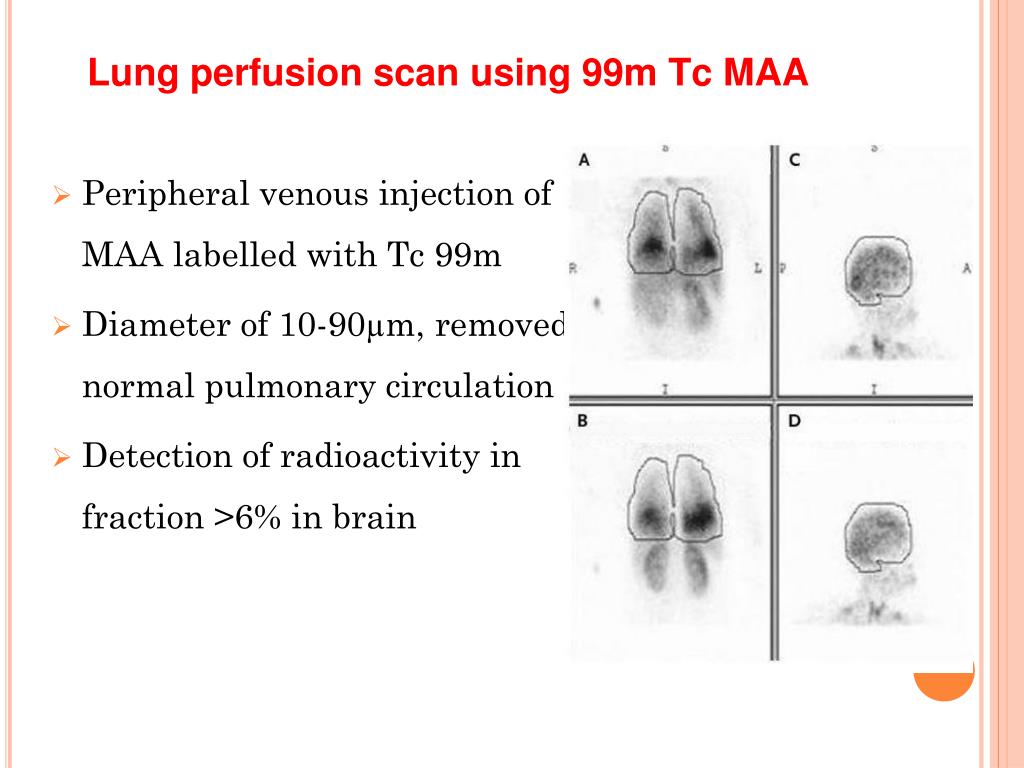 PPT - Hepatopulmonary syndrome and cirrhotic cardiomyopathy PowerPoint ...