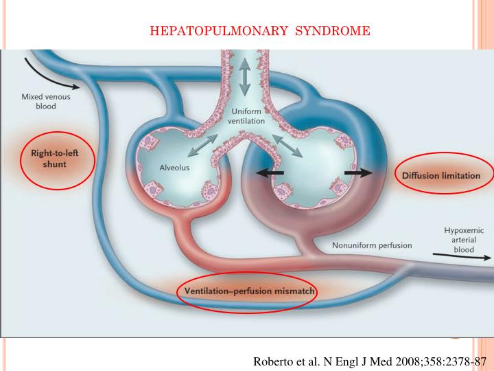 PPT - Hepatopulmonary syndrome and cirrhotic cardiomyopathy PowerPoint ...