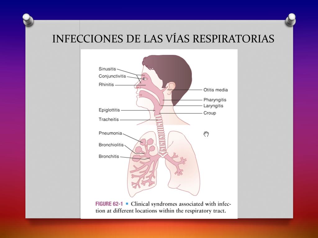 Ppt Infecciones De Las VÍas Respiratorias Generalidades Powerpoint