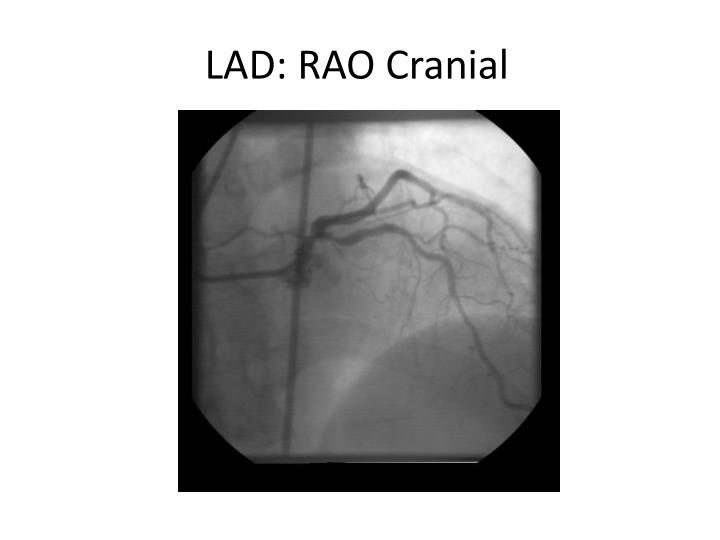 PPT - Coronary Anatomy, Variants and Lesion Characteristics PowerPoint ...