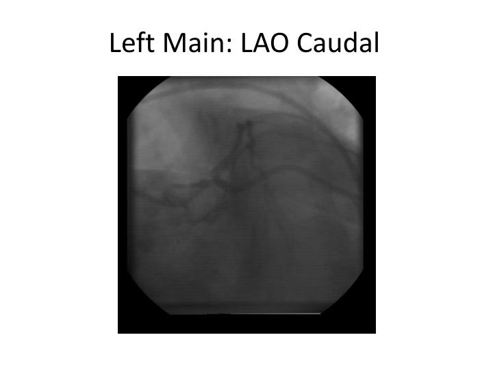 PPT - Coronary Anatomy, Variants and Lesion Characteristics PowerPoint ...