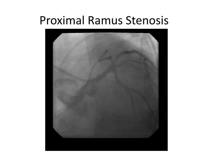 PPT - Coronary Anatomy, Variants and Lesion Characteristics PowerPoint ...