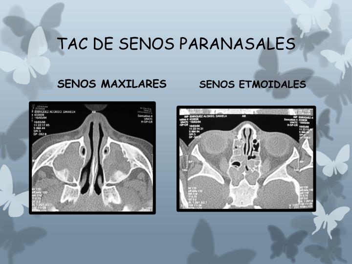 PPT - SINUSITIS PowerPoint Presentation - ID:1972924