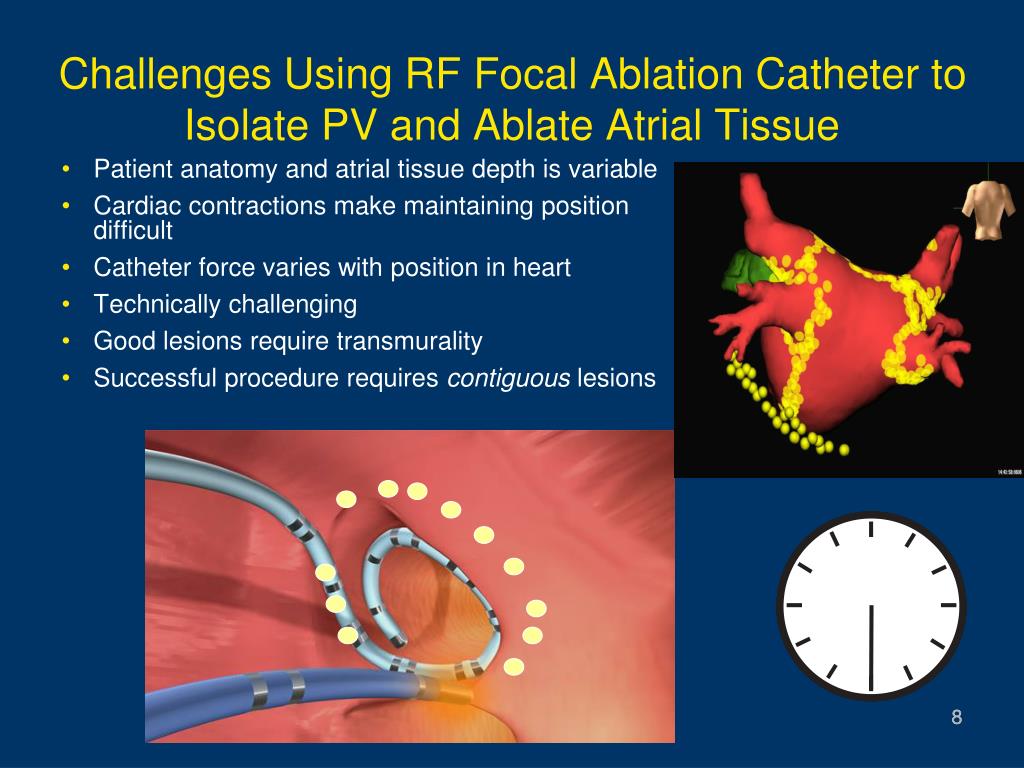 PPT - New Advances in Atrial Fibrillation Ablation: Cryoballoon-Based ...