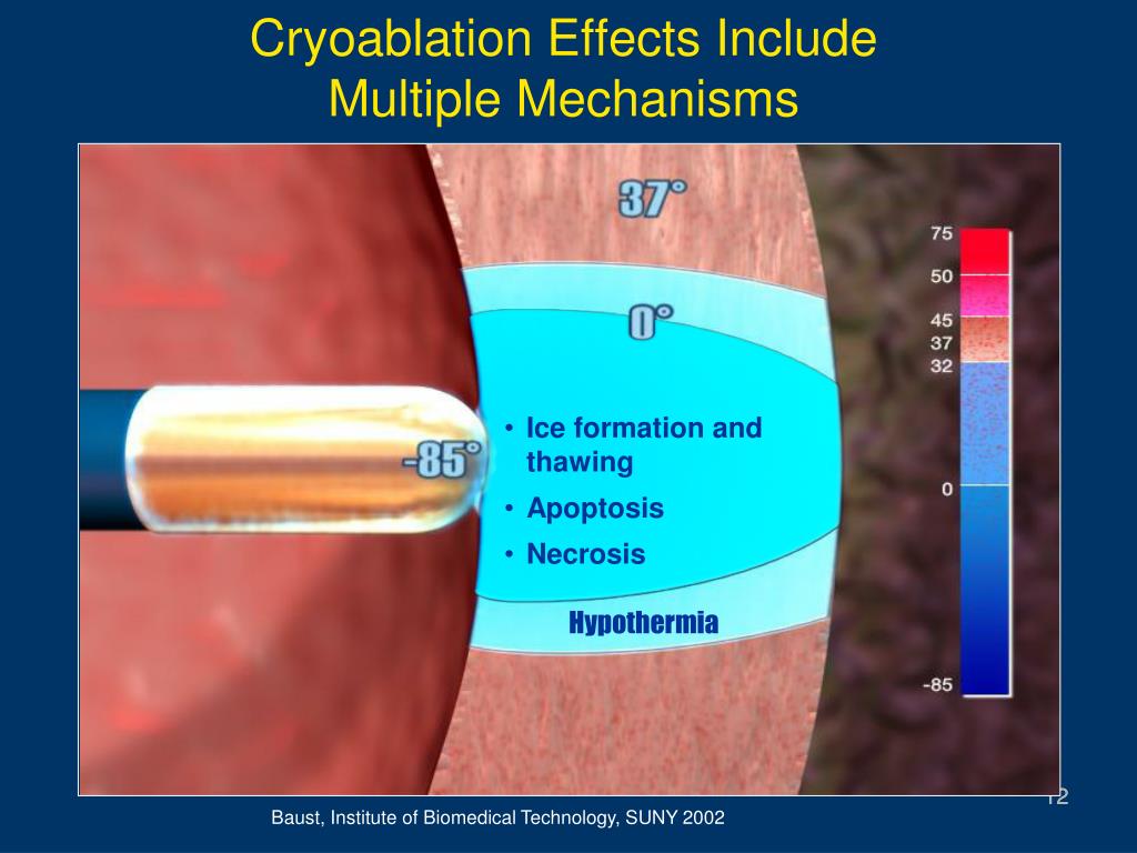PPT - New Advances in Atrial Fibrillation Ablation: Cryoballoon-Based ...