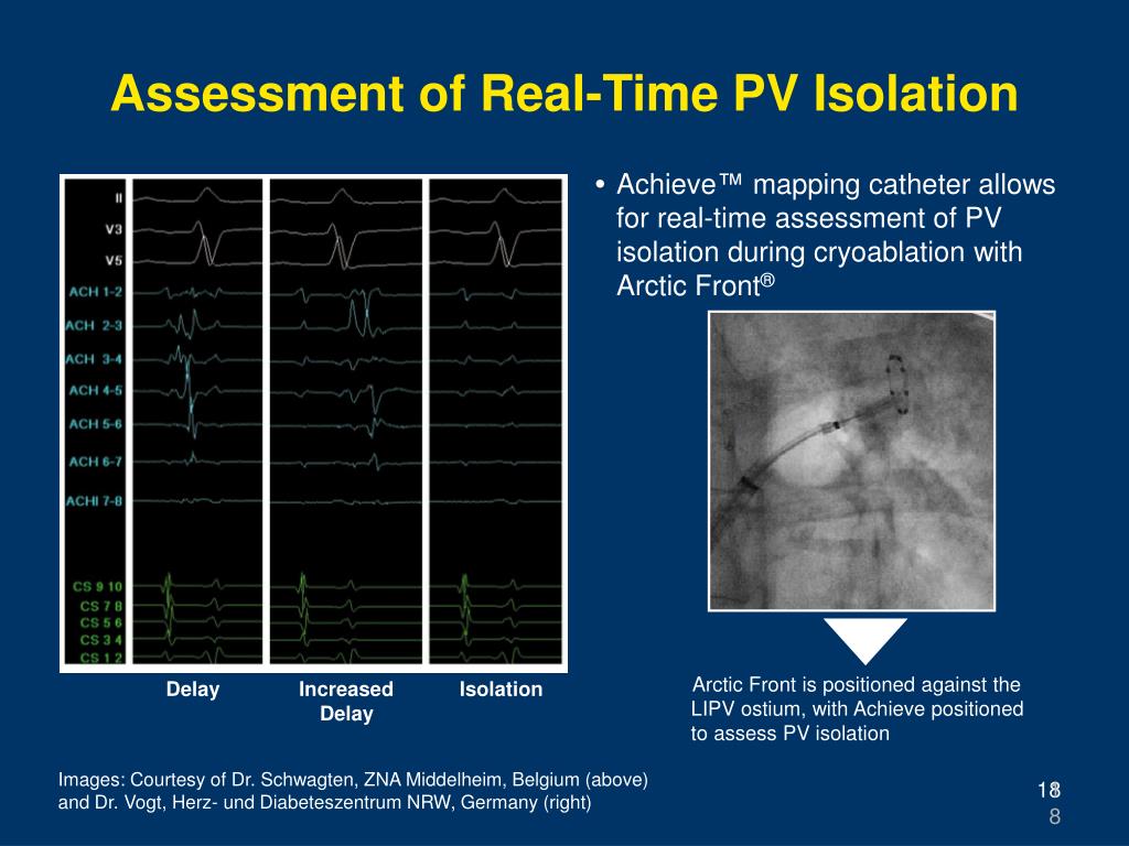 PPT - New Advances in Atrial Fibrillation Ablation: Cryoballoon-Based ...