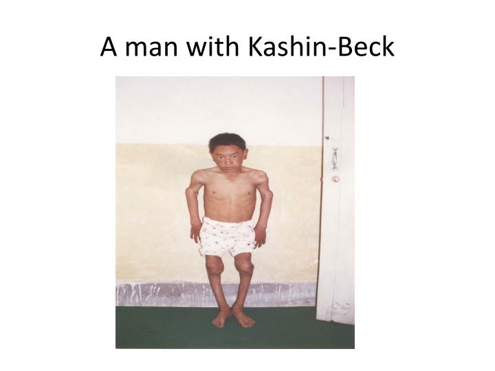 PPT - Kashin -Beck Disease PowerPoint Presentation - ID:1973065