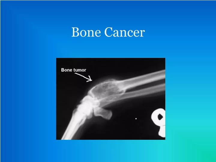 PPT - Bone Cancer PowerPoint Presentation, free download - ID:1973116