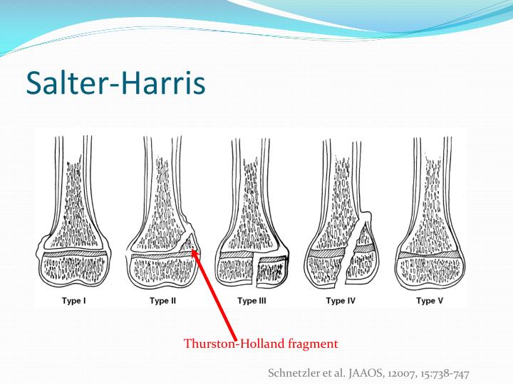 PPT - Pediatric Ankle Fractures PowerPoint Presentation - ID:1973792