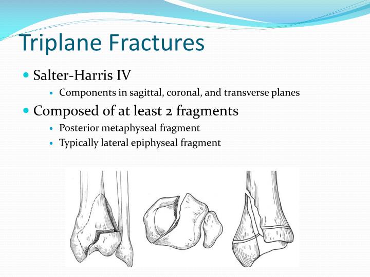 PPT - Pediatric Ankle Fractures PowerPoint Presentation - ID:1973792