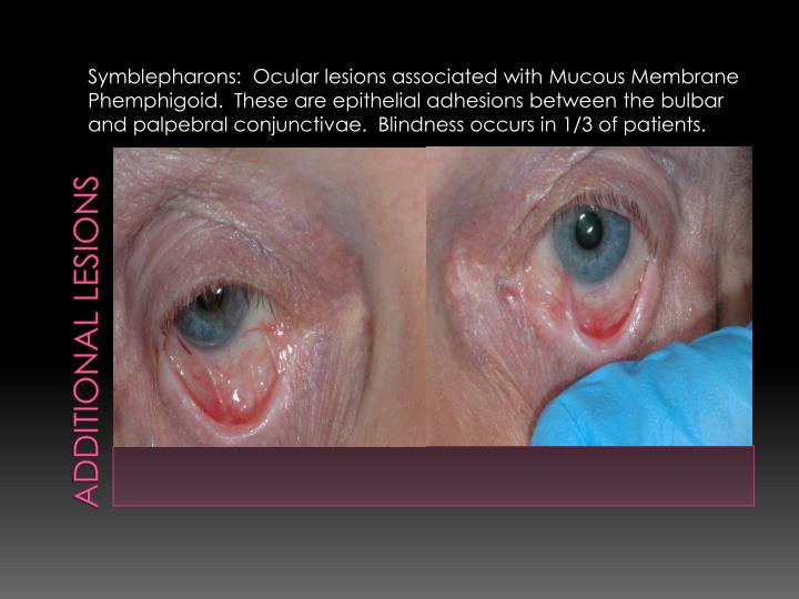 PPT - Benign Mucous Membrane Pemphigoid PowerPoint Presentation - ID ...