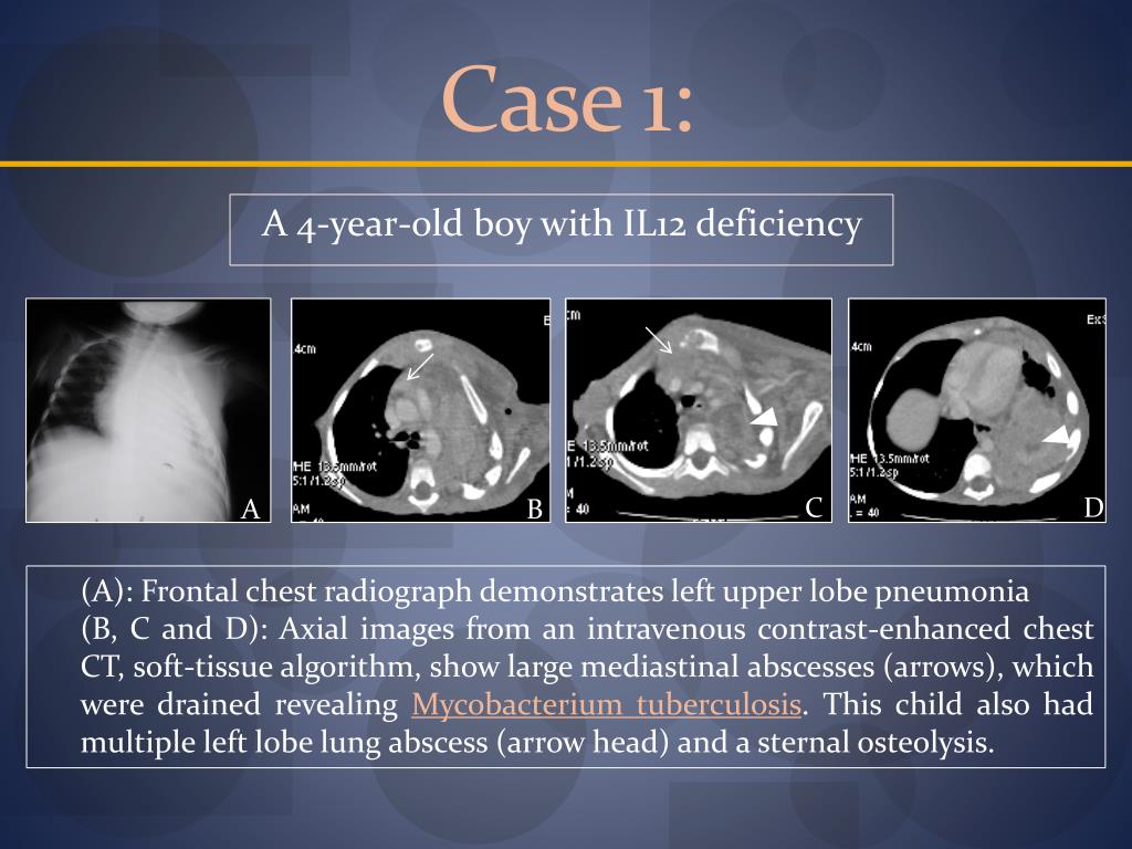 PPT - IMAGING OF CHEST INFECTIONS IN IMMUNOCOMPROMISED CHILD PowerPoint ...