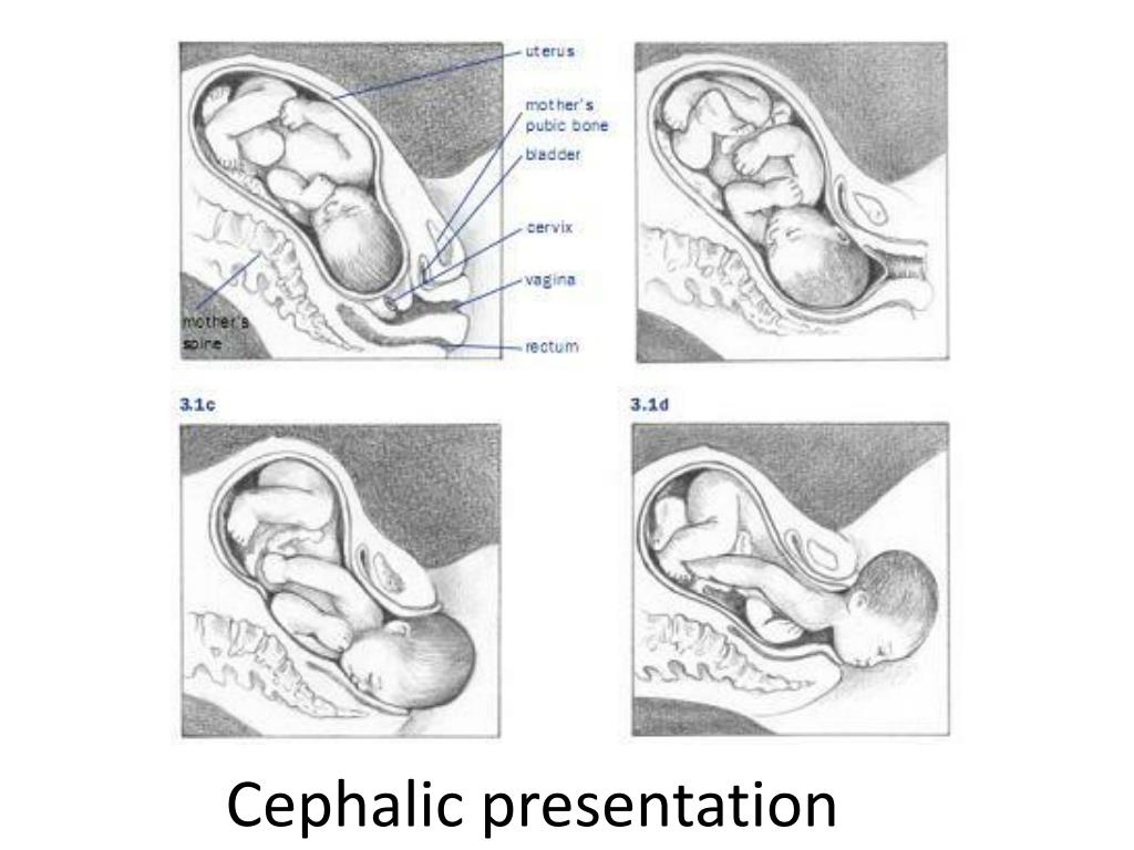 PPT - Aden/o------------gland Adenoma ---------tumor of a gland ...