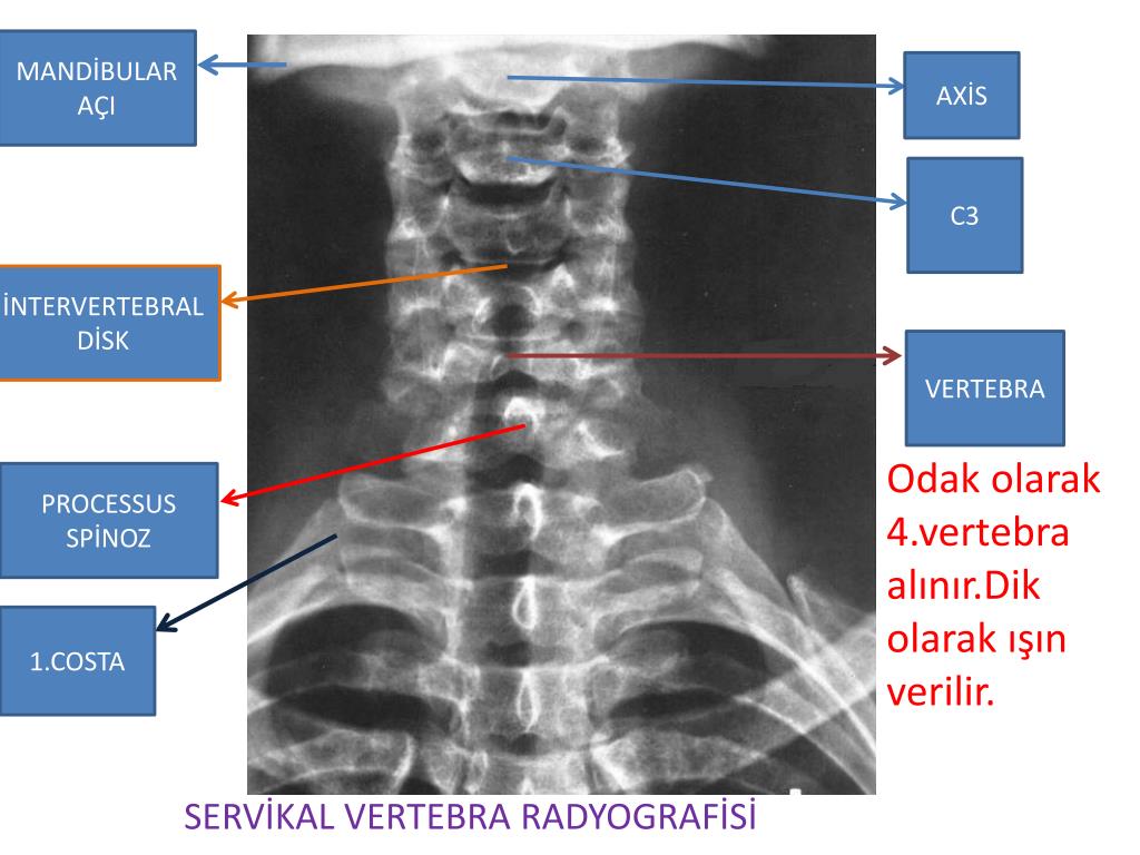 PPT - SERVİKAL,DORSAL,LUMBAR,SAKRAL VERTEBRALAR PowerPoint Presentation ...