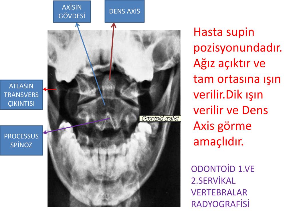 PPT - SERVİKAL,DORSAL,LUMBAR,SAKRAL VERTEBRALAR PowerPoint Presentation ...
