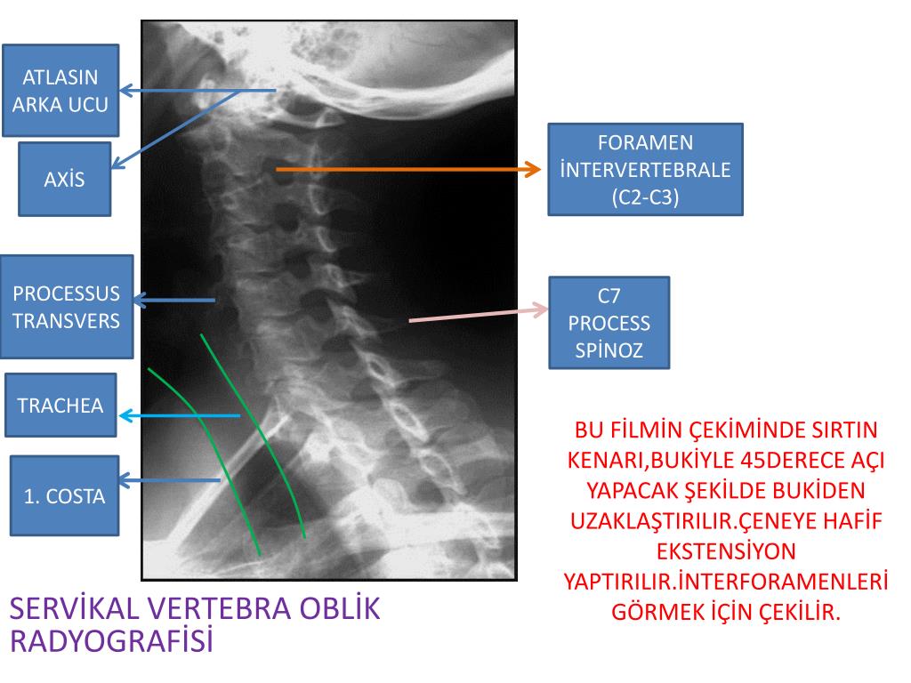 PPT - SERVİKAL,DORSAL,LUMBAR,SAKRAL VERTEBRALAR PowerPoint Presentation ...
