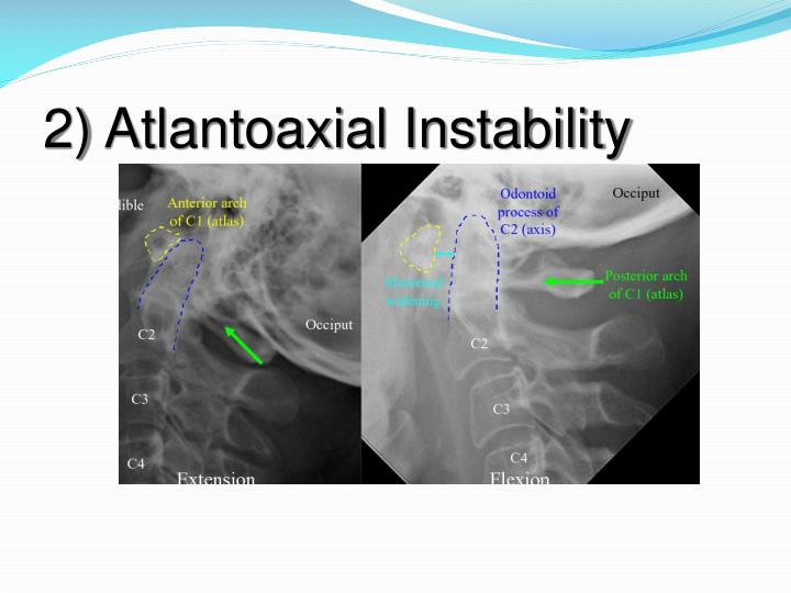 PPT - The Rheumatoid Elbow PowerPoint Presentation - ID:1980599