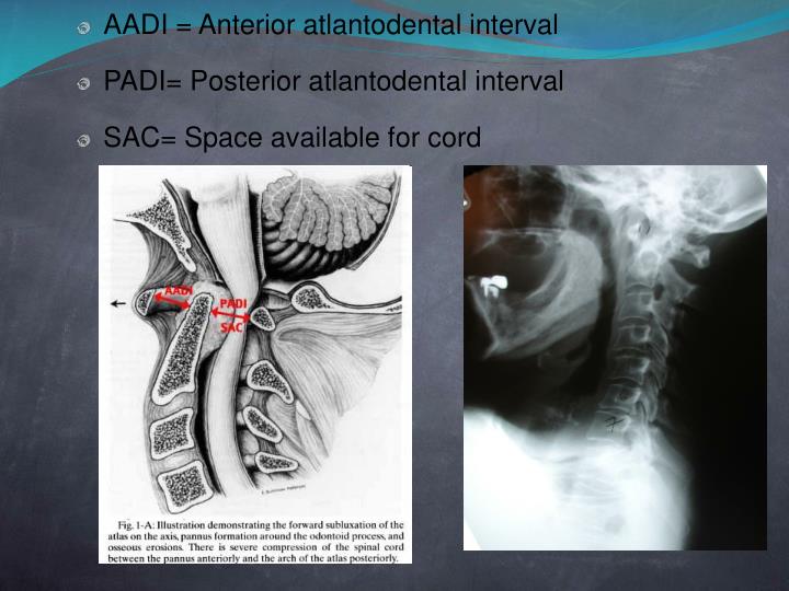 PPT - The Rheumatoid Elbow PowerPoint Presentation - ID:1980599