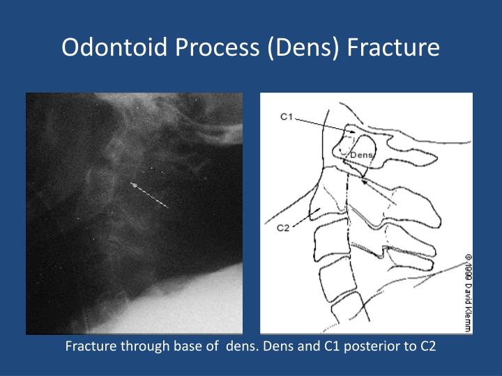 PPT - TRAUMA DE COLUMNA CERVICAL EN NIÑOS PowerPoint Presentation - ID ...