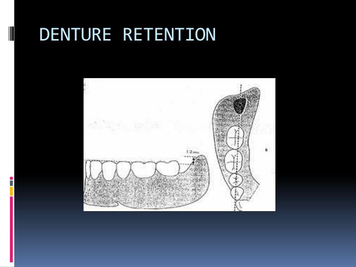 PPT - Dsp 332 principles of complete denture prosthodontics PowerPoint ...