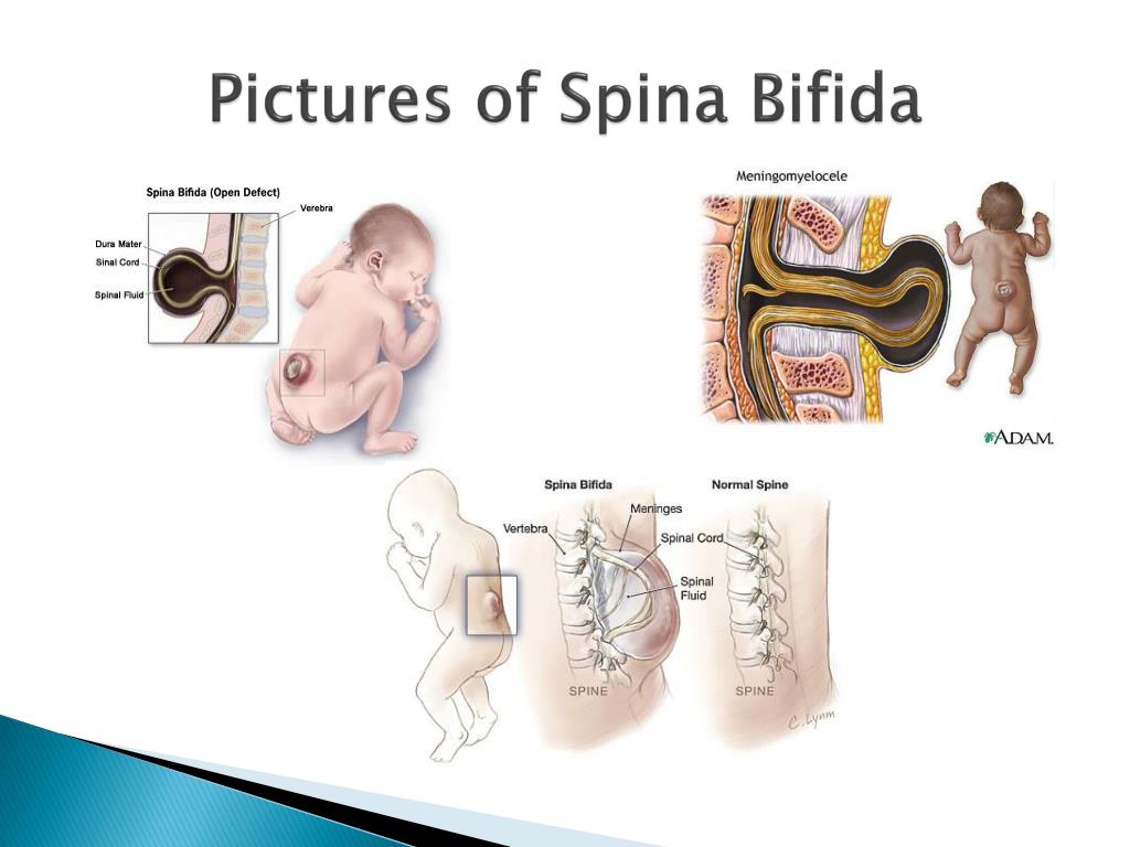 Ppt Spina Bifida Powerpoint Presentation Free Download Id 1983654