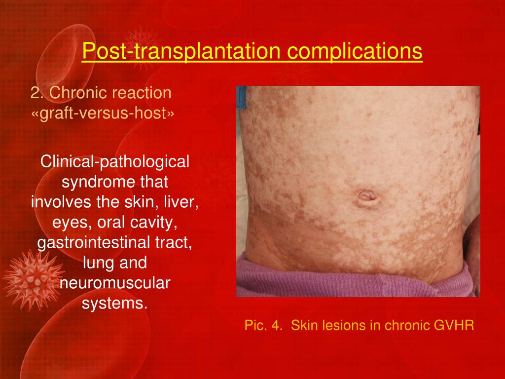 PPT - Transplantation of hematopoietic stem cells in pediatric oncology ...