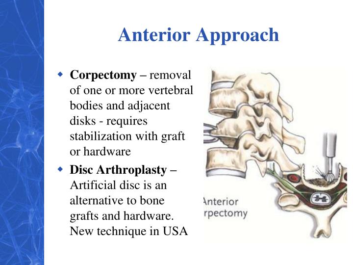 PPT - Cervical Spine Surgery 101 PowerPoint Presentation - ID:1987135