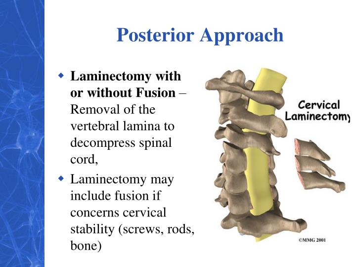 PPT - Cervical Spine Surgery 101 PowerPoint Presentation - ID:1987135
