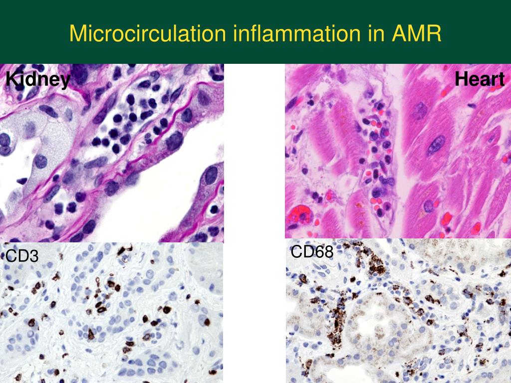 PPT - Microvascular inflammation and endothelial cell activation in ...