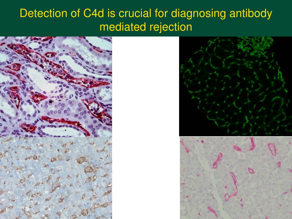 PPT - Microvascular inflammation and endothelial cell activation in ...