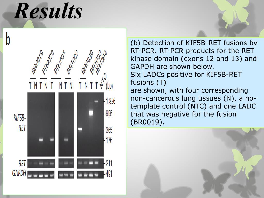 PPT - KIF5B-RET fusions in lung adenocarcinoma PowerPoint Presentation ...