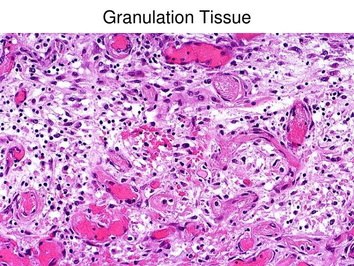 PPT - Inflammation & Repair PowerPoint Presentation - ID:1993668