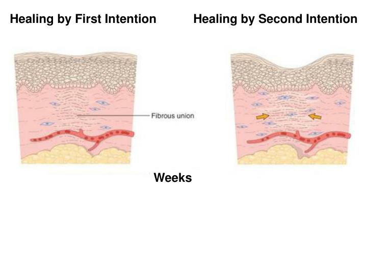 PPT - Inflammation & Repair PowerPoint Presentation - ID:1993668
