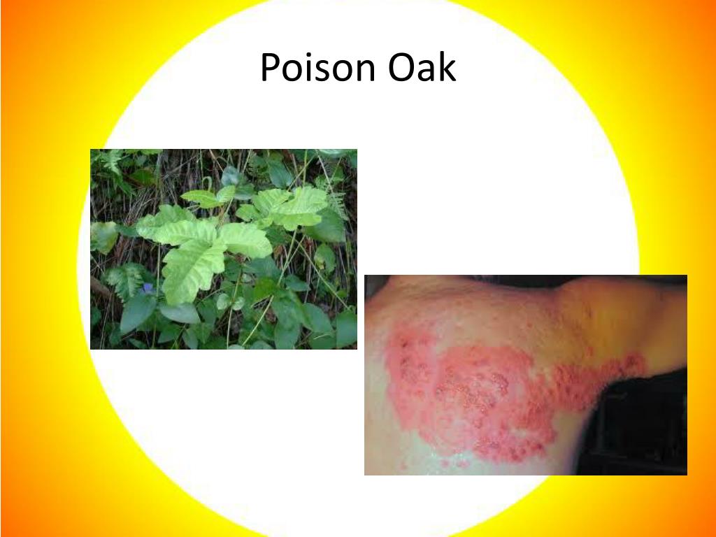 PPT - Summer Skin Burns, Bites & Abrasions PowerPoint Presentation - ID ...